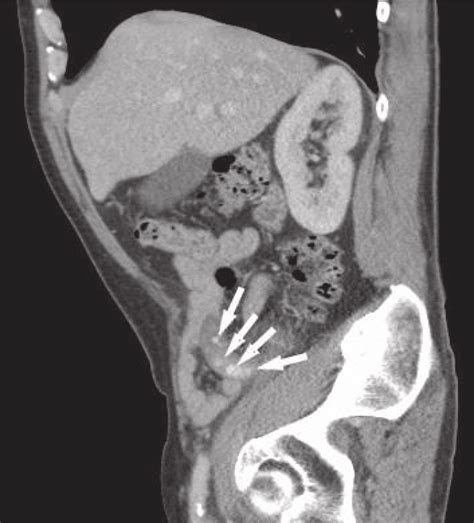Sagittal View Of The Abdominal Ct Showing Multiple Appendicoliths