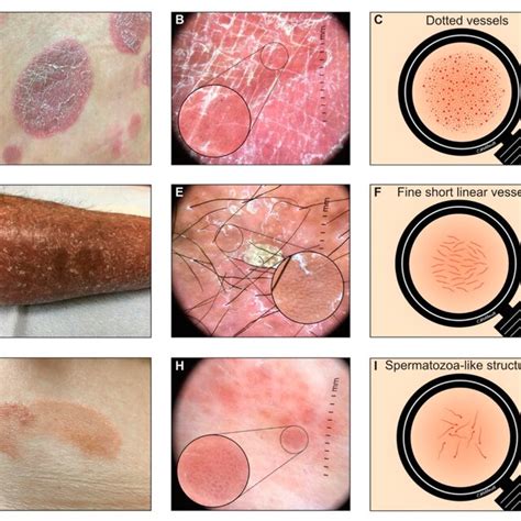 A I Vascular Patterns Dermoscopic Features Of Vascular Patterns