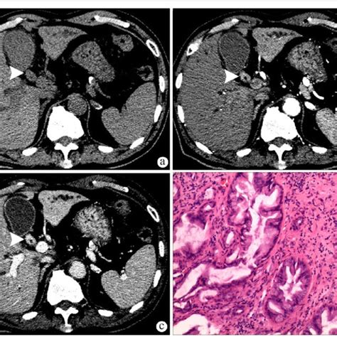 A Patient With Hilar Cholangiocarcinoma A D Hilar Cholangiocarcinoma Download Scientific