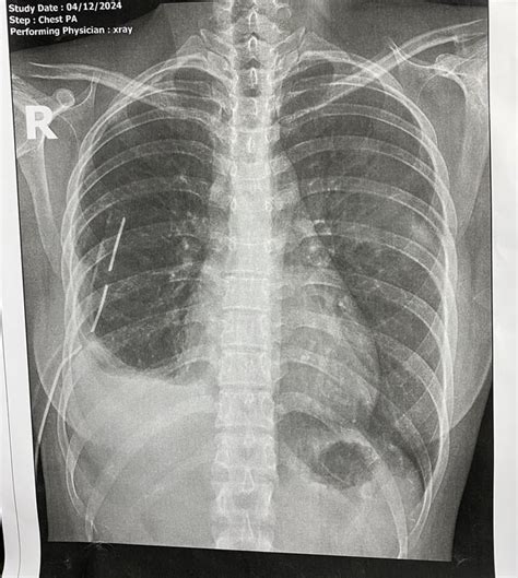 How Bad Is My Pleural Thickening And Minimal Pleural Effusion After My