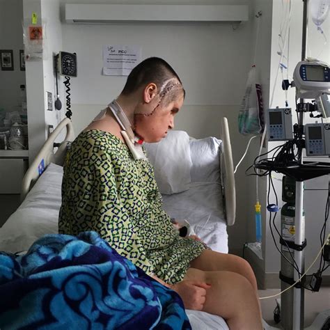 How A Face Transplant Transformed A Young Womans Life National