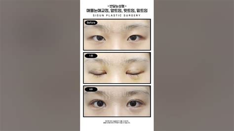 [시선성형외과 반달눈성형]매몰눈매교정 앞트임 윗트임 밑트임 6주 Shorts Youtube