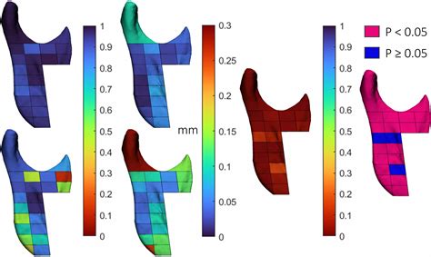 Comparison Of Surface And Voxel Based Registration On The Mandibular