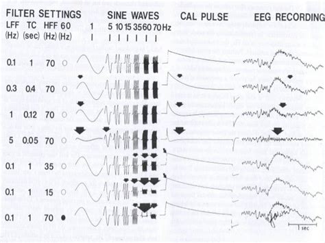 Eeg Machine Filters Eeg Machine Filters