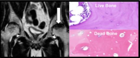 Benign Bone Pathologies Flashcards Quizlet