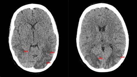 Brain Ct Scan Showing Areas Of Hypo Attenuation Involving Predominantly