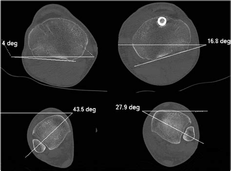 Figure 1 From Prevalence Of Rotational Malalignment After Infrapatellar Versus Suprapatellar