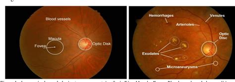 Figure 1 From Detection Of Retinal Abnormalities In Fundus Image Using Cnn Deep Learning
