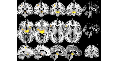The Interaction Analysis Contrast Iv The Right Motor Cortex