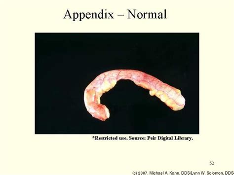 How Big Is A Normal Appendix At Alexis Owen Blog