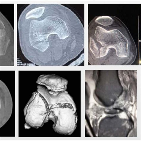 Radiological Images As Per The New Classification System Download Scientific Diagram