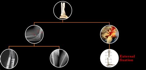 Fracture Treatment Methods Download Scientific Diagram