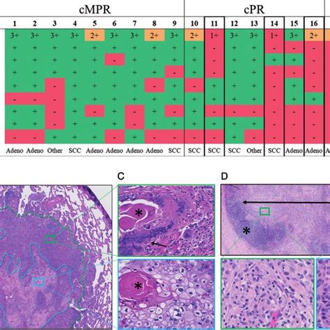 Histologic Features Of Pathologic Response To Neoadjuvant Anti Pd 1 In