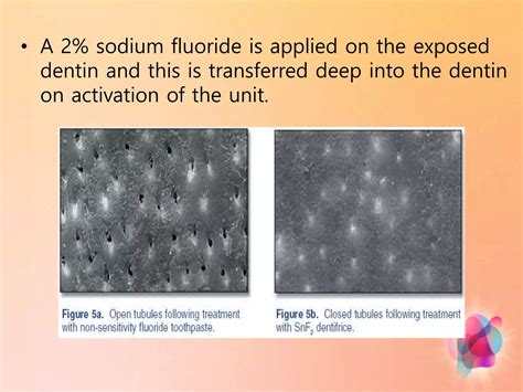 Hypersensitivity Of Teeth And Its Management Pptx