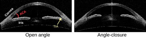 Angle Closure Glaucoma Vs Open Angle