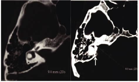 A Preoperative Ct Scan Showing Enlargement Of The Iac B