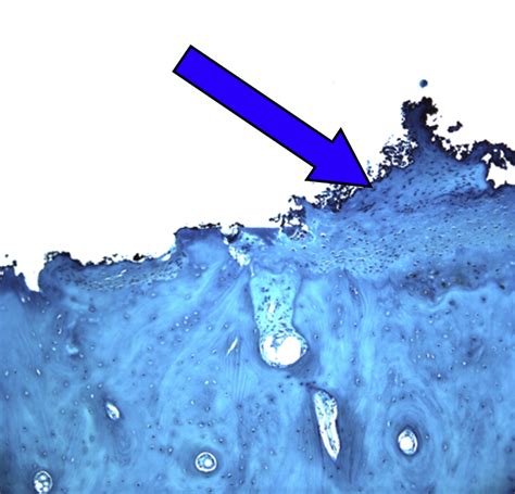 The New Microfracture All Things Considered Arthroscopy