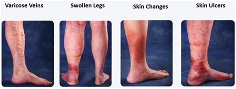 Varicose And Spider Veins Venous Institute Of Buffalo