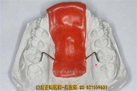 口腔正畸粘结式tpa（2） 山东周医生 口腔正畸医师周茂强的博客 Kq88口腔博客