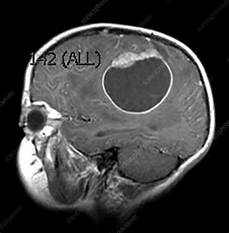 Primitive Neuroectodermal Tumour Pnet Mri Stock Image C043 3159 Science Photo Library