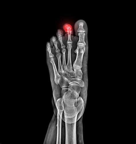 Sprained Toe Vs Broken Toe Understanding The Differences FatLadSays