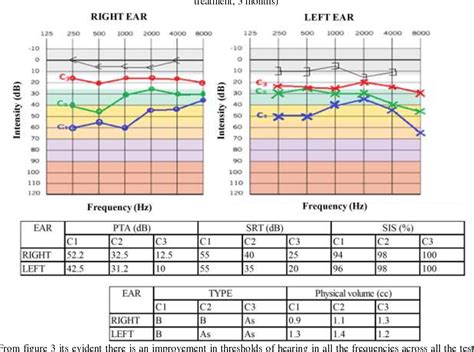 Otitis Media Audiogram Example At Diane Carey Blog Otitis Media Audiogram Example At Diane Carey Blog