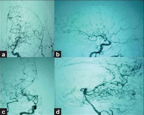 Four Vessel Cerebral Angiography Showing Bilateral Stenosis Of The Download Scientific Diagram