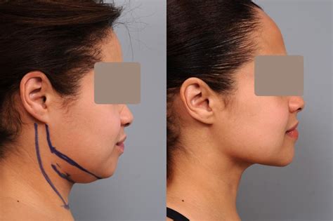What Is Lipo Nyc Liposuction Nyc Ggnyu