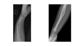 Pediatric Fractures Pptx