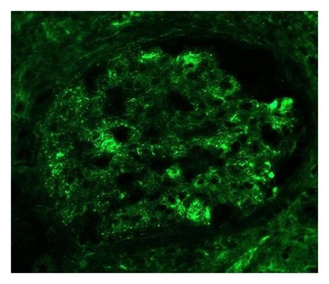 A Fibrocellular Crescent In Bowmans Space With Significant Collapse