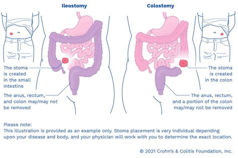 Ileostomy Vs Colostomy Colostomy Ileostomy Ostomy Colostomy Vs