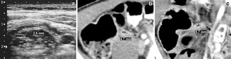 Sample Measurements Of The Proximal Appendix On Us A Axially