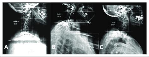 Example Of The Range Of Cervical Sagittal Alignment A Kyphotic
