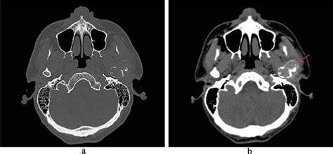 A Bone And B Soft Tissue Algorithm Axial Ct Images Showing An