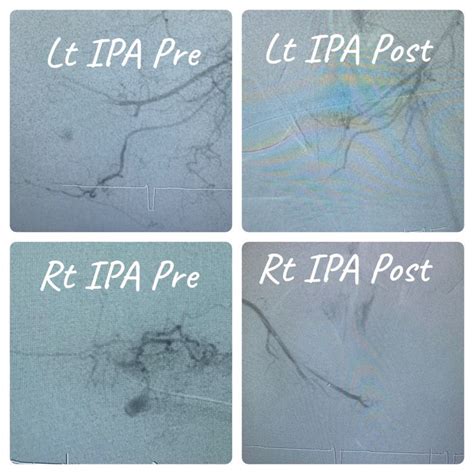Dr Avinash Kumar Auf Linkedin Isvir Minimallyinvasivesurgery Irforembolization