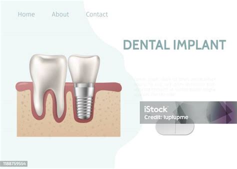 임플란트 및 건강한 치아 및 구조 벡터 그림 치과 진료소 웹 사이트를위한 모든 부품 크라운 어버트먼트 나사가있는 치과 임플란트 구조 금속에 대한 스톡 벡터 아트 및 기타