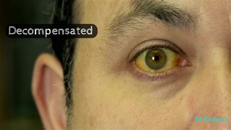 Eyes Object Detection Dataset By Classification