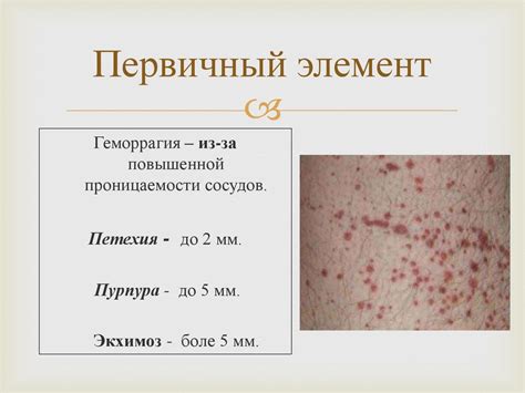 Экзантемы у детей презентация онлайн