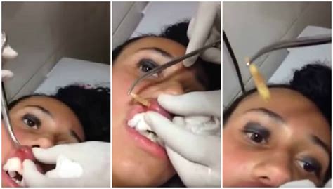 Botfly Removal From Human
