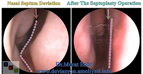 Causes Nasal Septum Deviation