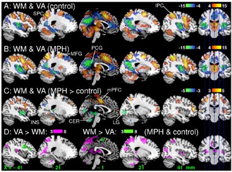 Brain Activation Patterns Rendered To A Structural Mri Image