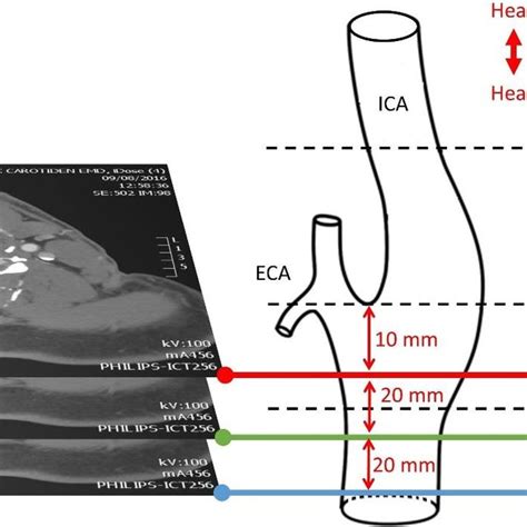 Schematic Rendition Of The Cca And The Bifurcation Ct Slice 1 Was