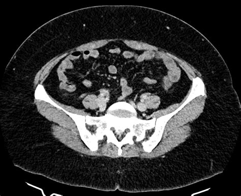 Filecholedocholithiasis Cholangitis And Portal Vein Thrombophlebitis