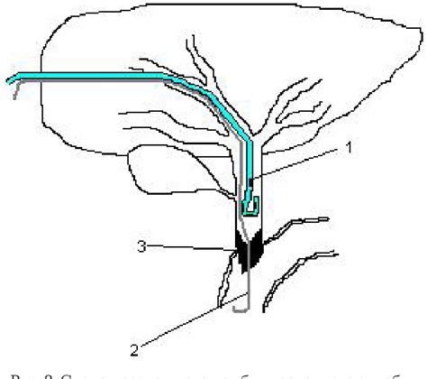 Figure 1 From Prevention Of Purulent Cholangitis After Percutaneous Endobiliary Transpapillary