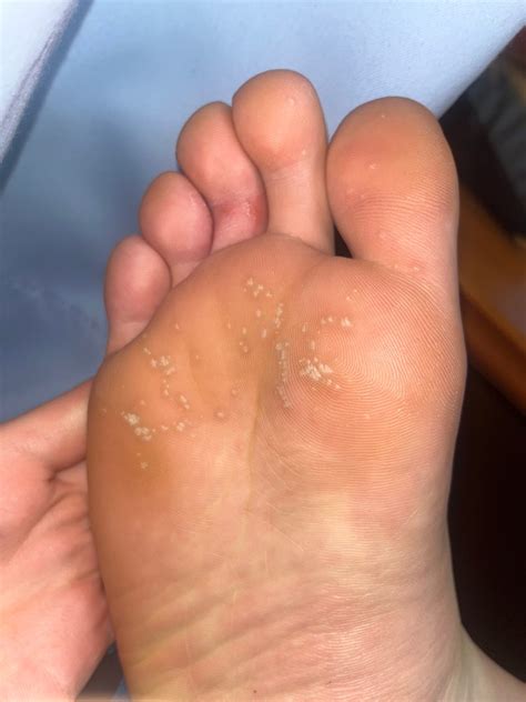 발바닥 굳은살 무좀 티눈 알려주세요 제발 ㅜㅜ 지식in