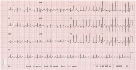 Neonatal Supraventricular Tachycardia Svt Meded Cases