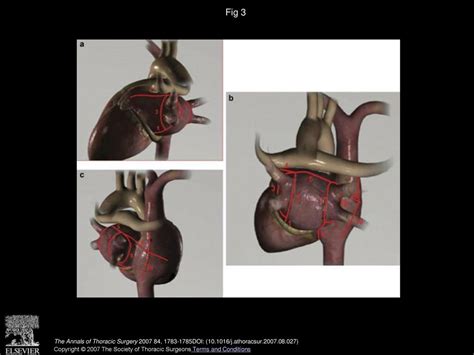 Totally Extracardiac Maze Procedure Performed On The Beating Heart