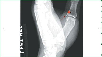 Gamekeepers Thumb Skiers Thumb Applied Radiology