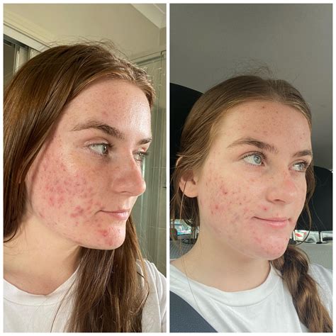 One Month Of Tretinoin And Doxycycline R Tretinoin