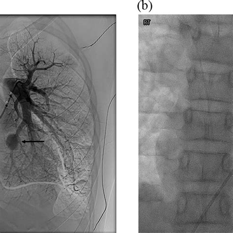 A Dsa Demonstrates A 12 Mm Pseudoaneurysm Black Arrow Arising From Download Scientific
